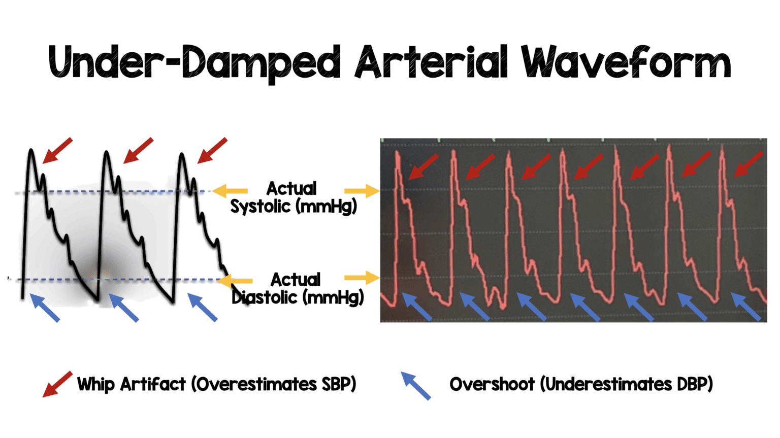 Damping and Arterial Lines - REBEL EM - Emergency Medicine Blog