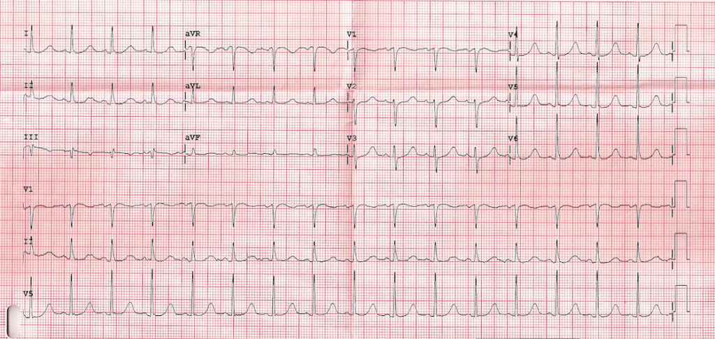 REBEL Core Cast 88.0 - Hypocalcemia - REBEL EM - Emergency Medicine Blog