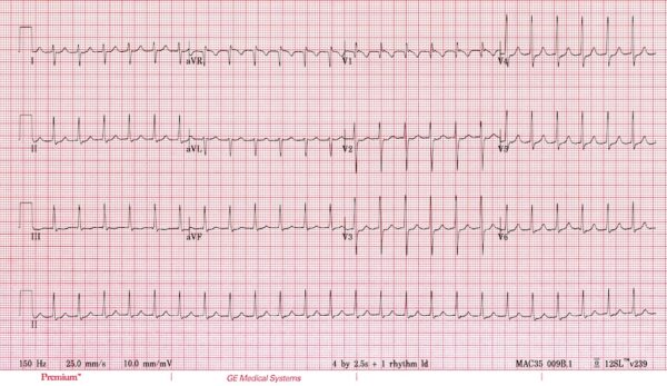 REBEL Core Cast 98.0 - AVNRT - REBEL EM - Emergency Medicine Blog