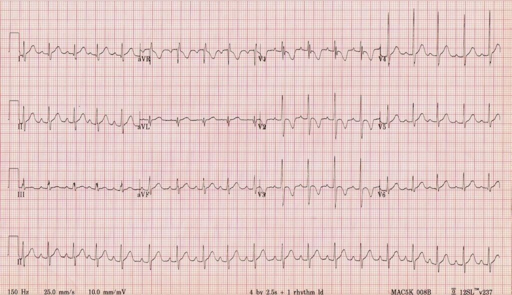 Incomplete RBBB (LITFL) - REBEL EM - Emergency Medicine Blog
