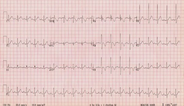 Incomplete RBBB (LITFL) - REBEL EM - Emergency Medicine Blog