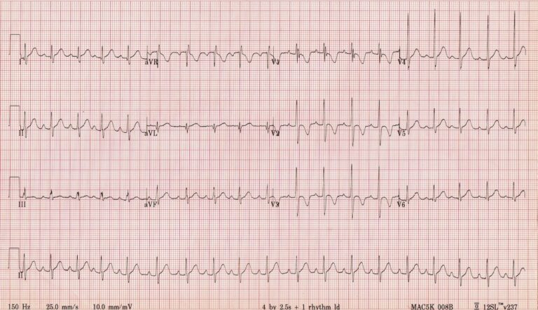 Incomplete RBBB (LITFL) - REBEL EM - Emergency Medicine Blog