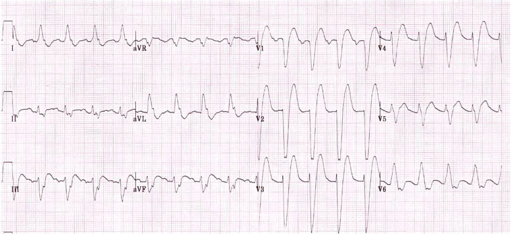 LBBB (LITFL) - REBEL EM - Emergency Medicine Blog