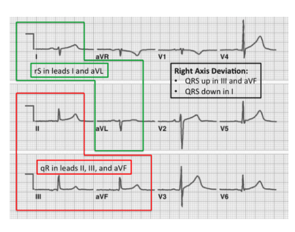 REBEL Core Cast 99.0 - Bundle Branch Blocks - REBEL EM - Emergency ...