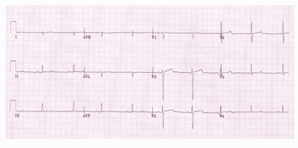 REBEL Core Cast 99.0 - Bundle Branch Blocks - REBEL EM - Emergency ... REBEL Core Cast 99.0 - Bundle Branch Blocks - REBEL EM - Emergency ...