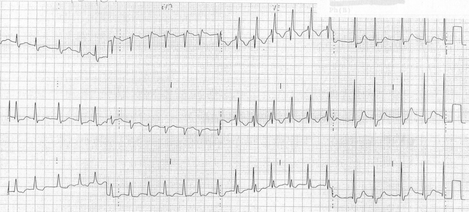 RBBB (LITFL) - REBEL EM - Emergency Medicine Blog