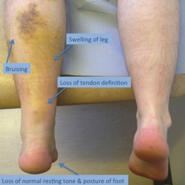 REBEL Core Cast 116.0 - Achilles Tendon Rupture - REBEL EM - Emergency ...