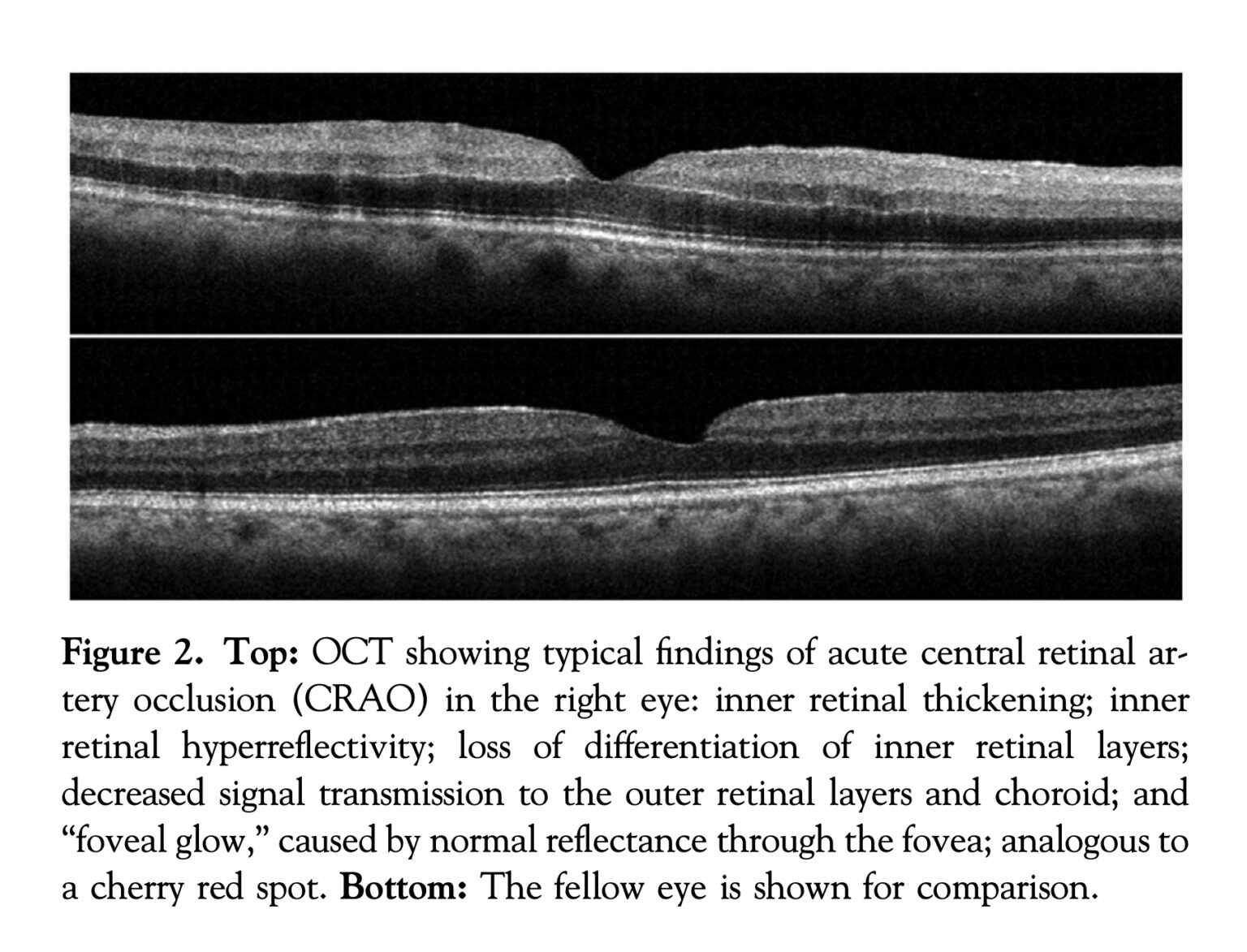 Remote Consult Protocols for Retinal Artery Occlusion: A Visionary ...