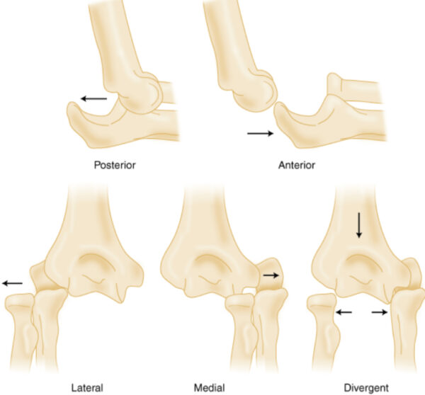 Elbow Dislocations - REBEL EM - Emergency Medicine Blog