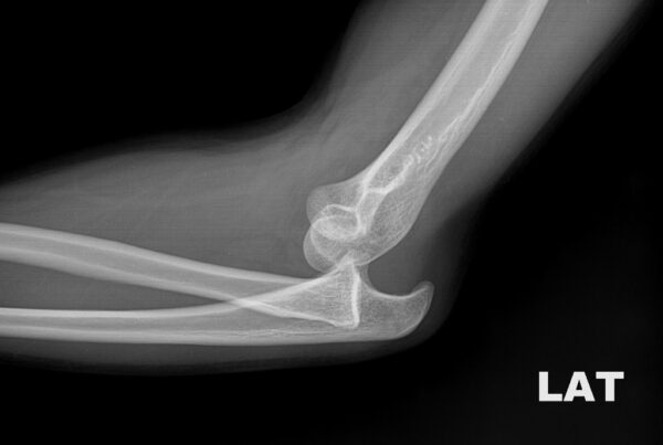 Elbow Dislocations - REBEL EM - Emergency Medicine Blog