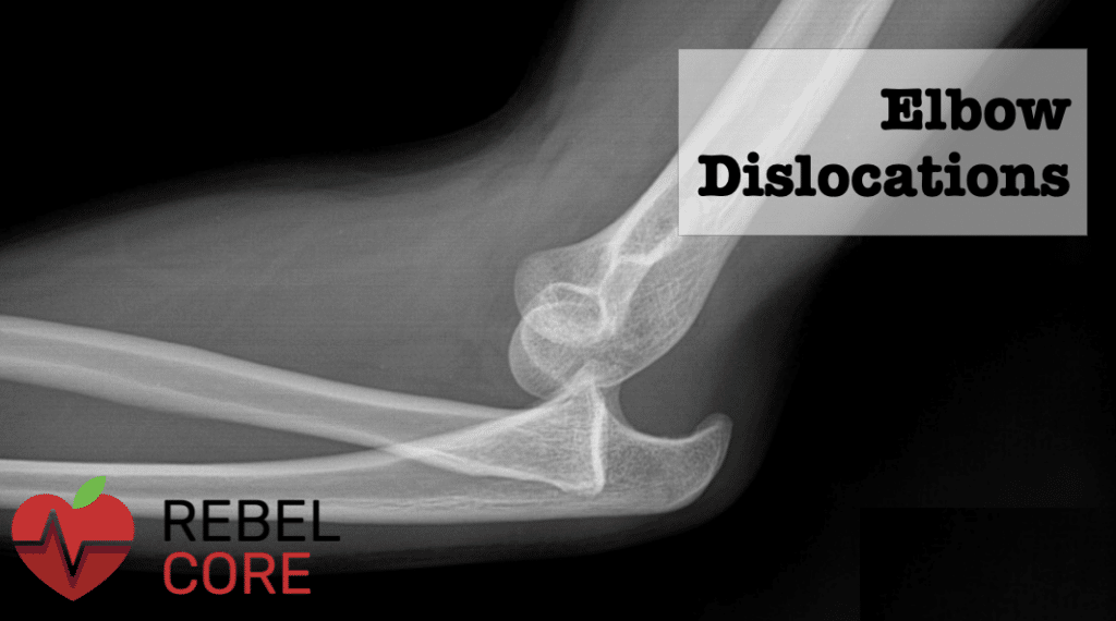 Elbow Dislocations - REBEL EM - Emergency Medicine Blog